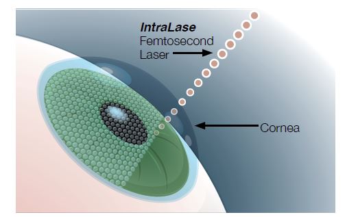 LASIK Surgery to Correct Your Vision at NCEENT